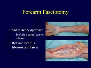 Compartment Syndrome.ppt