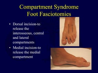 Compartment Syndrome.ppt