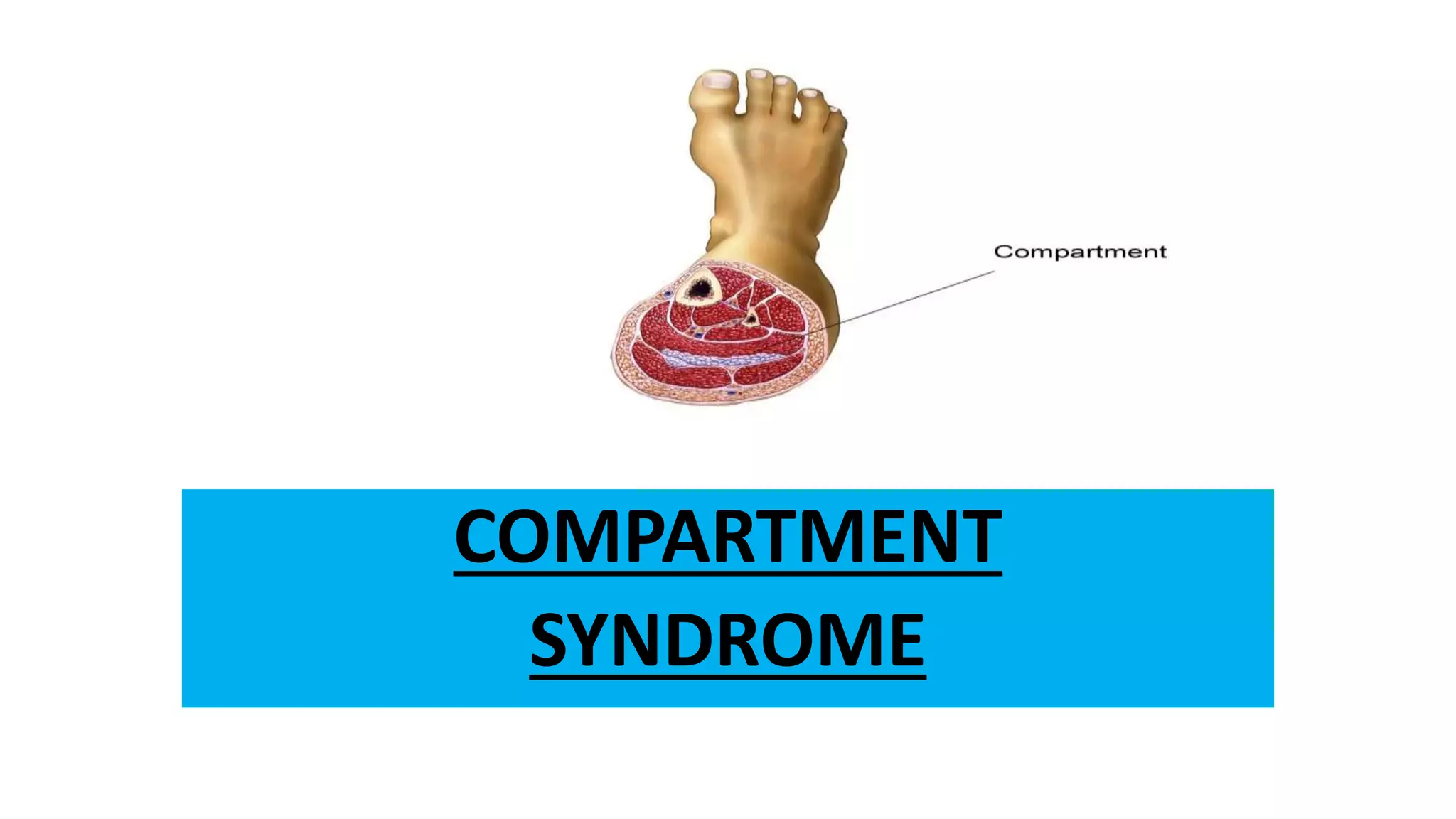 COMPARTMENT SYNDROME.pptx