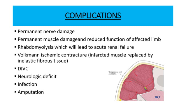 COMPARTMENT SYNDROME.pptx
