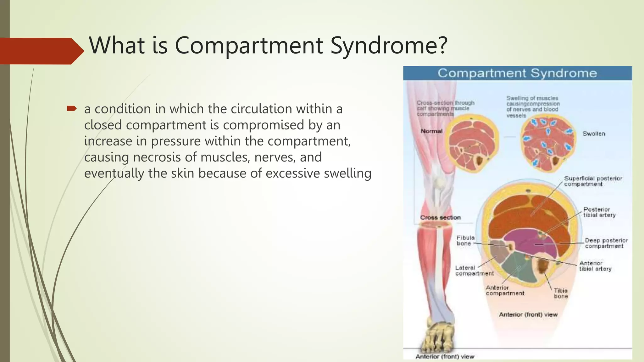compartment syndrome.pptx