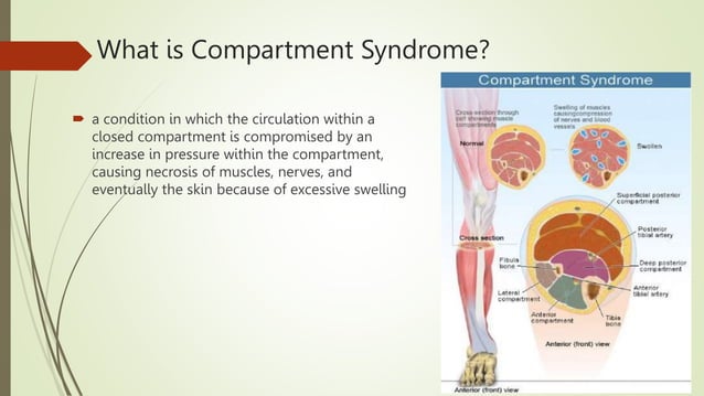 compartment syndrome.pptx