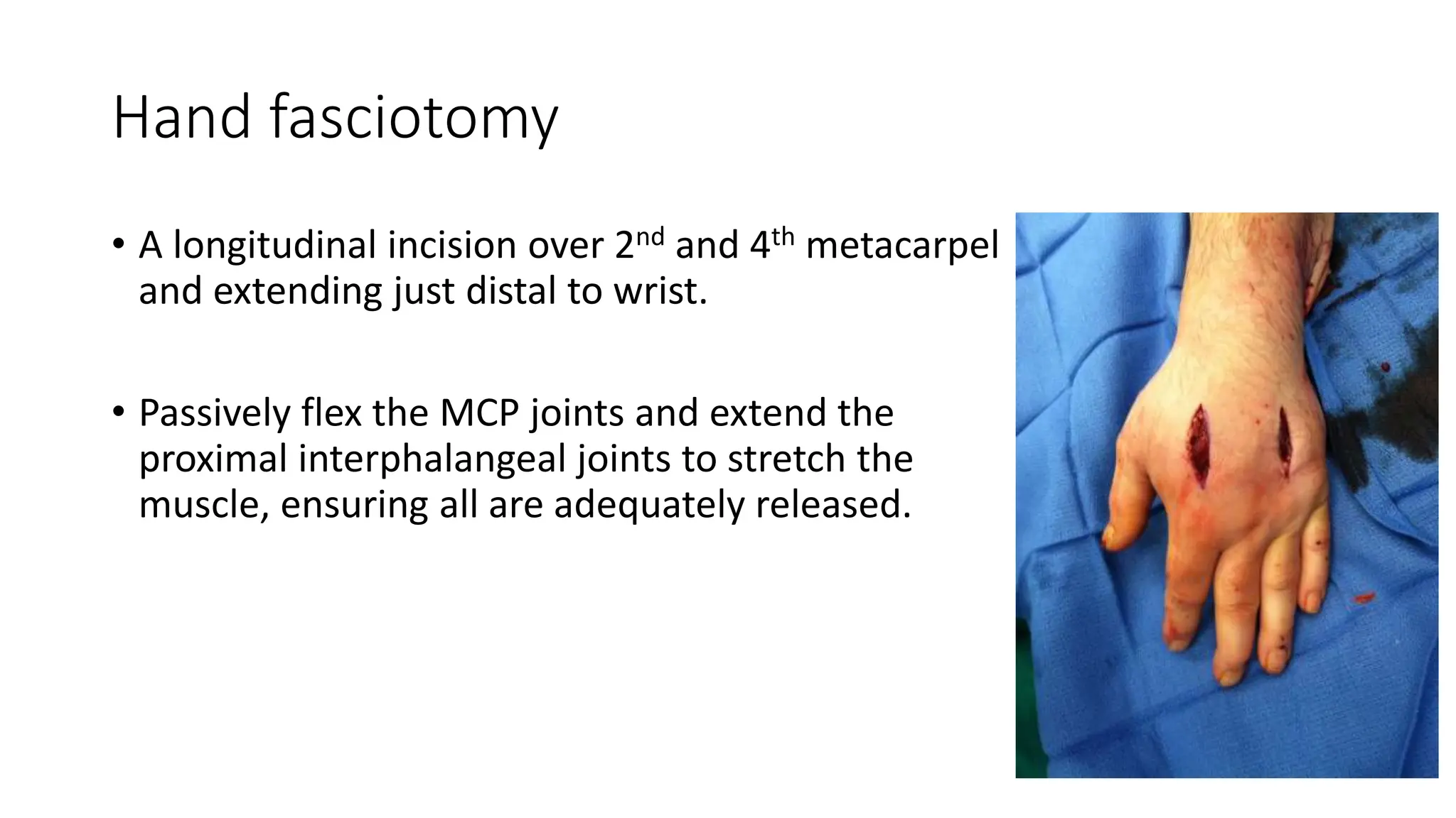 compartment syndrome.pptx