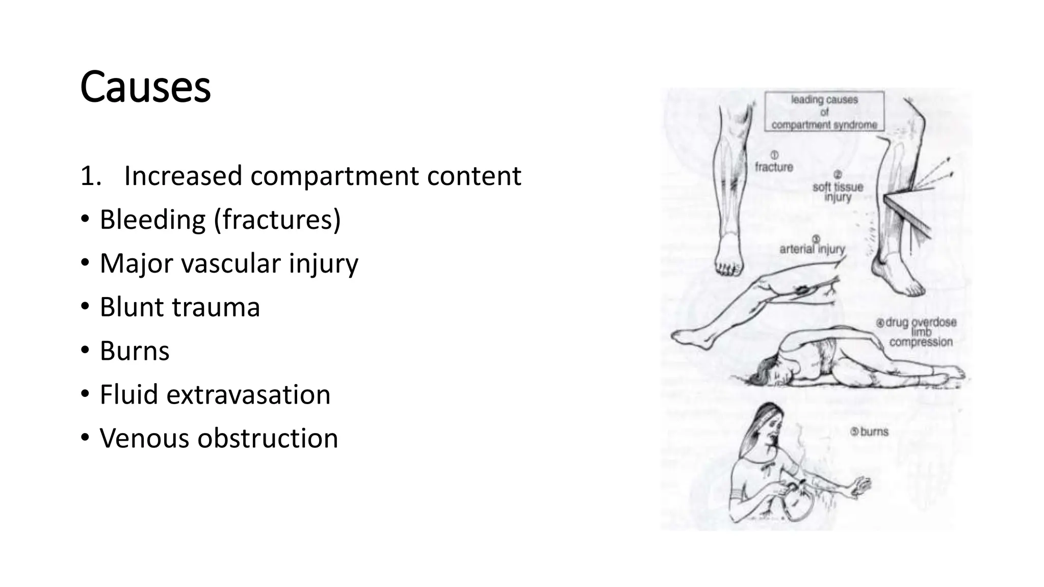 compartment syndrome.pptx