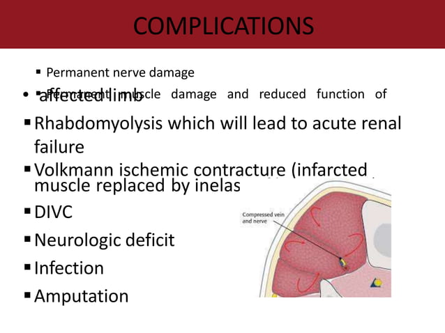 COMPARTMENT SYNDROME ORTHO MANAGEMENT.pptx
