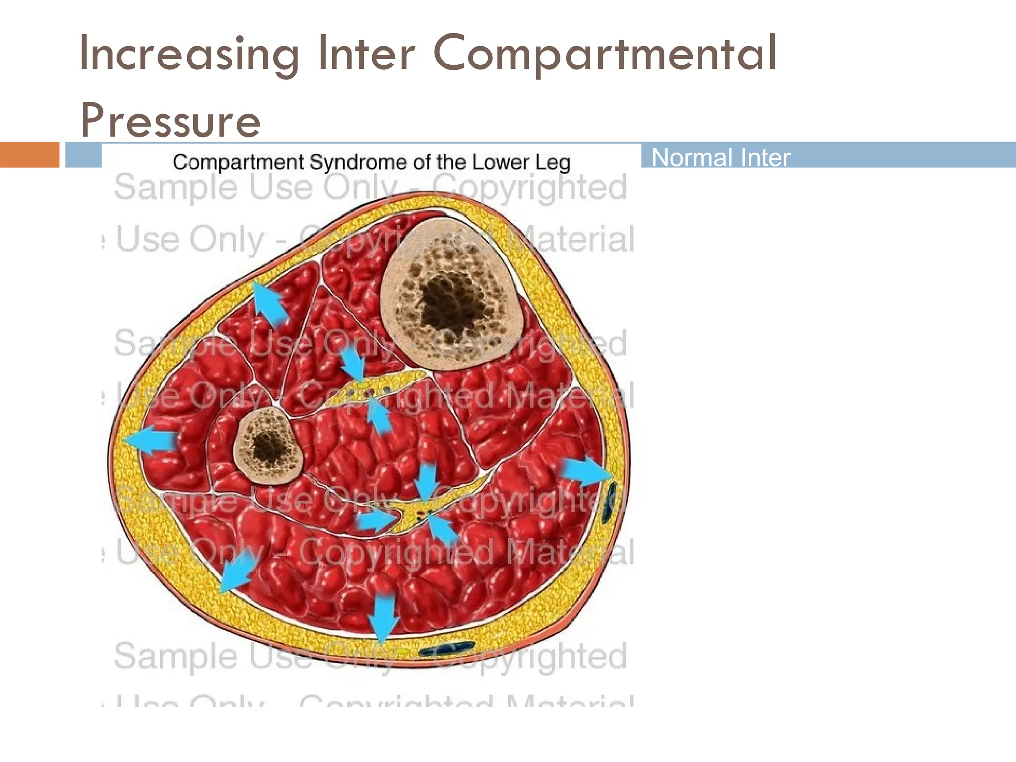 Compartment Syndrome.PowerPoint Presentation (2).ppt | Free Download