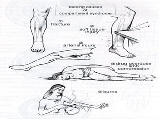 Compartment Syndrome.PowerPoint Presentation (2).ppt | Free Download
