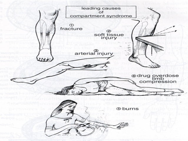 Compartment Syndrome.PowerPoint Presentation (2).ppt | Free Download