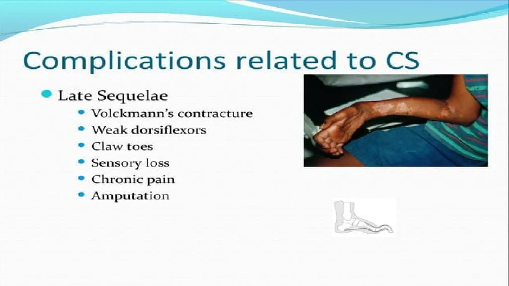 Compartment Syndrome Orthopaedic Mbbs.pptx