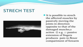 Compartment Syndrome Orthopaedic Mbbs.pptx