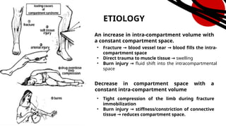 COMPARTMENT SYNDROME.............................. | PPTX
