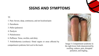 COMPARTMENT SYNDROME.............................. | PPTX