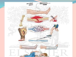 COMPARTMENT SYNDROME , CLINICAL FEATURES & MANAGEMENT.ppt