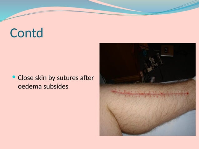 COMPARTMENT SYNDROME , CLINICAL FEATURES & MANAGEMENT.ppt