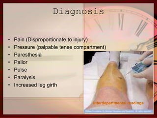 Compartment_Syndrome - COK ver 02112022.ppt