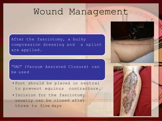 Compartment_Syndrome - COK ver 02112022.ppt