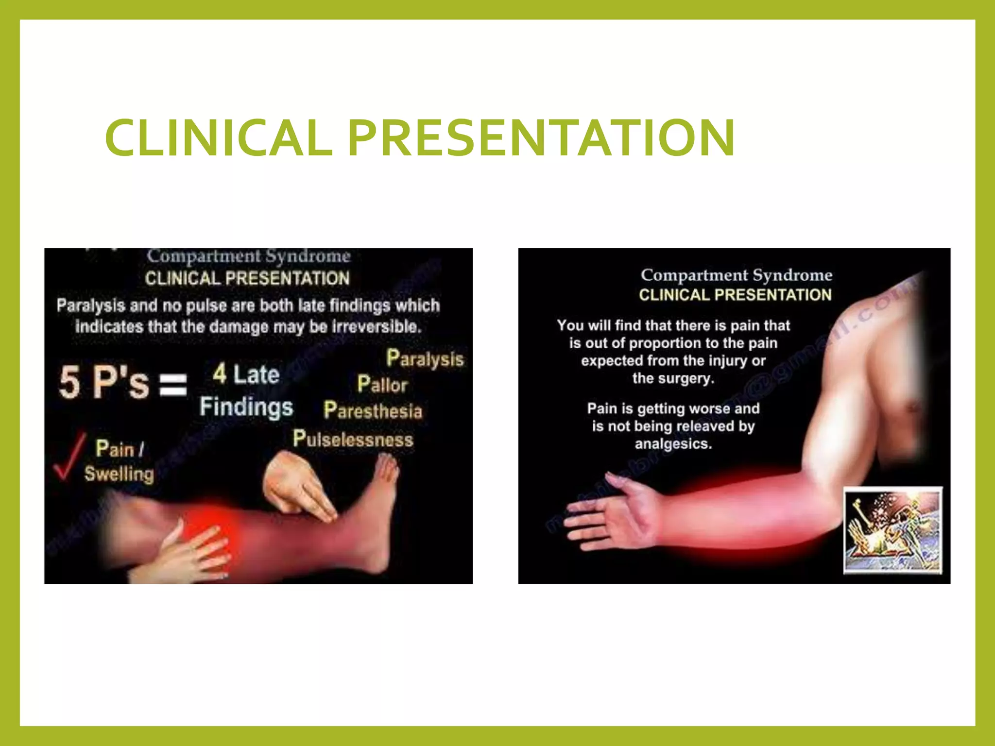 COMPARTMENT SYNDROME (2) (1).pptx