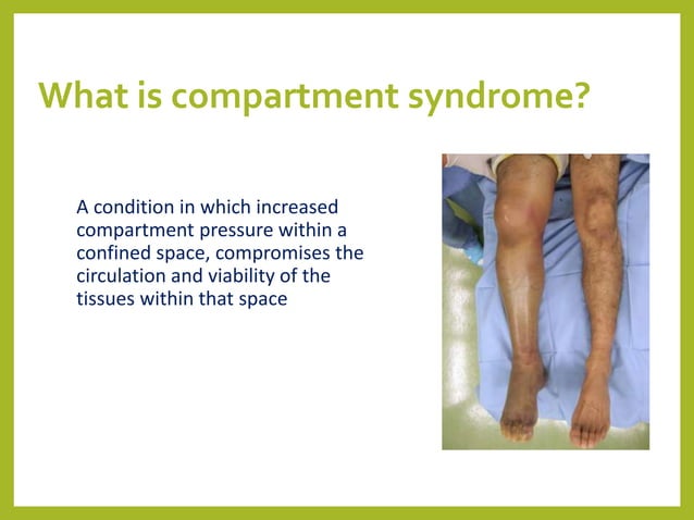 COMPARTMENT SYNDROME (2) (1).pptx