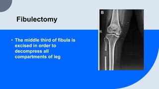 Compartment Syndrome seoeooeosnnsjsjndndndndn | PPT
