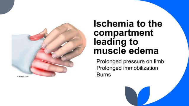 Compartment Syndrome seoeooeosnnsjsjndndndndn | PPT