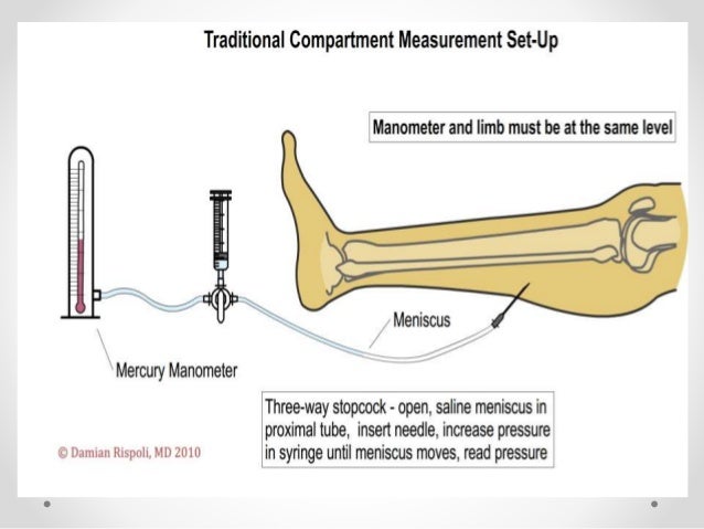 Compartment Syndrome