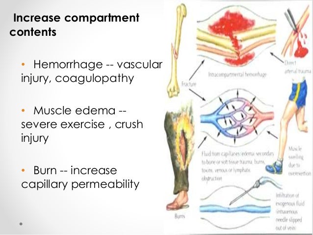 Compartment Syndrome