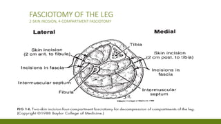 Compartment syndrome | PPTX