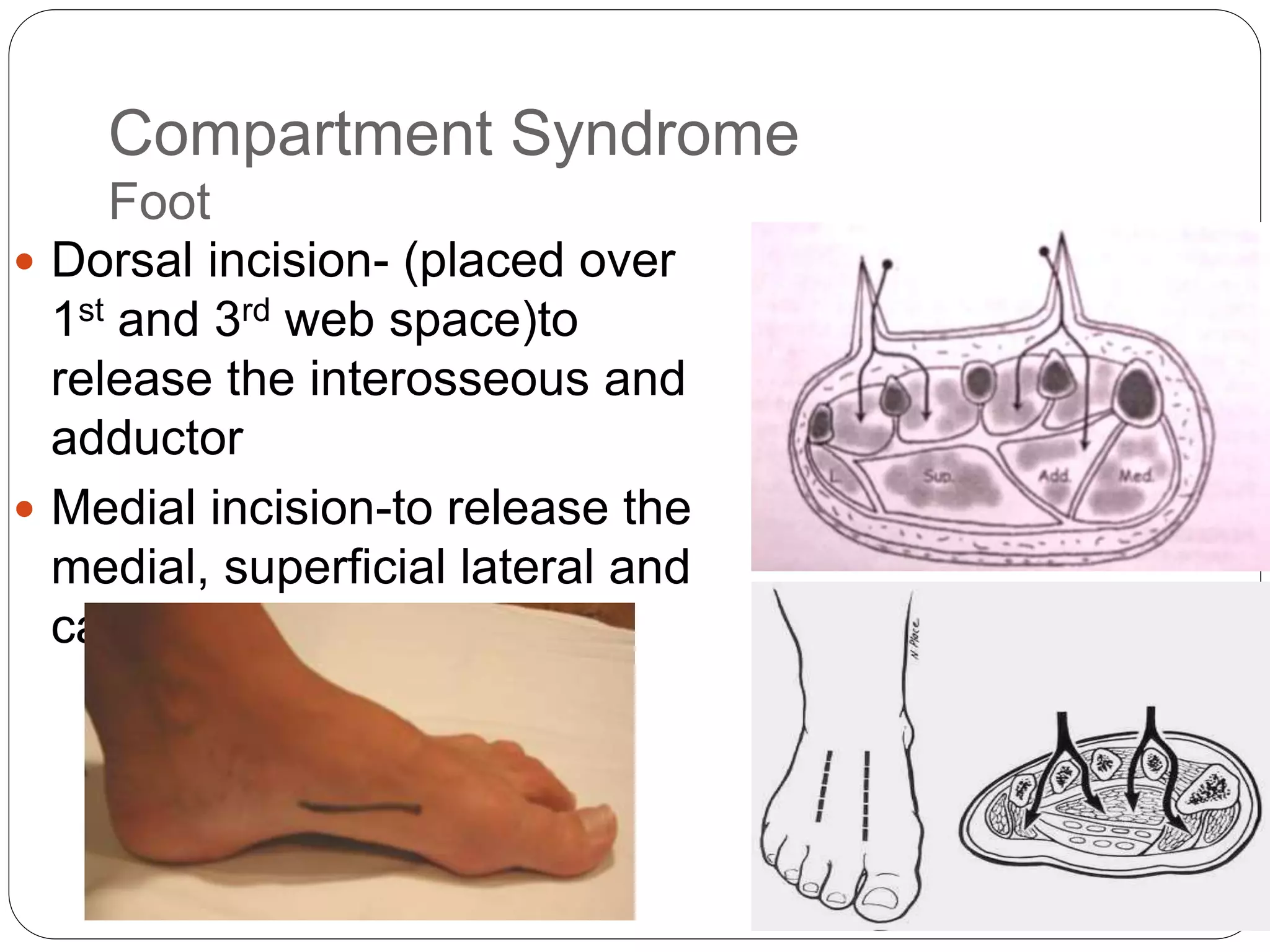 Compartment syndrome in orthopaedics | PPTX
