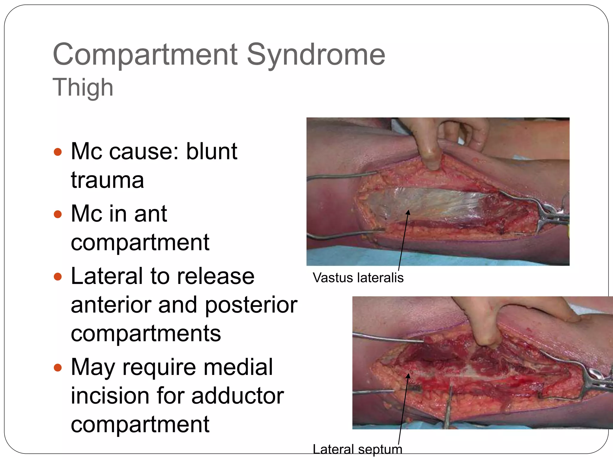Compartment syndrome in orthopaedics | PPTX