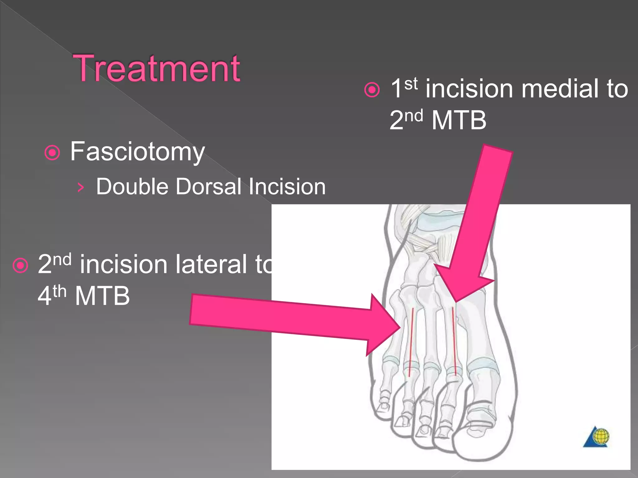 Compartment Syndrome Of The Foot.pptx