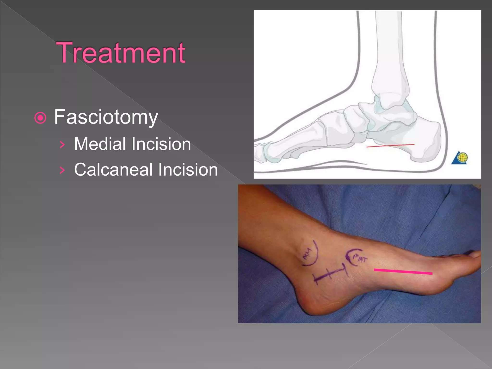 Compartment Syndrome Of The Foot.pptx