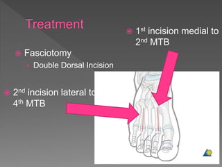 Compartment Syndrome Of The Foot.pptx