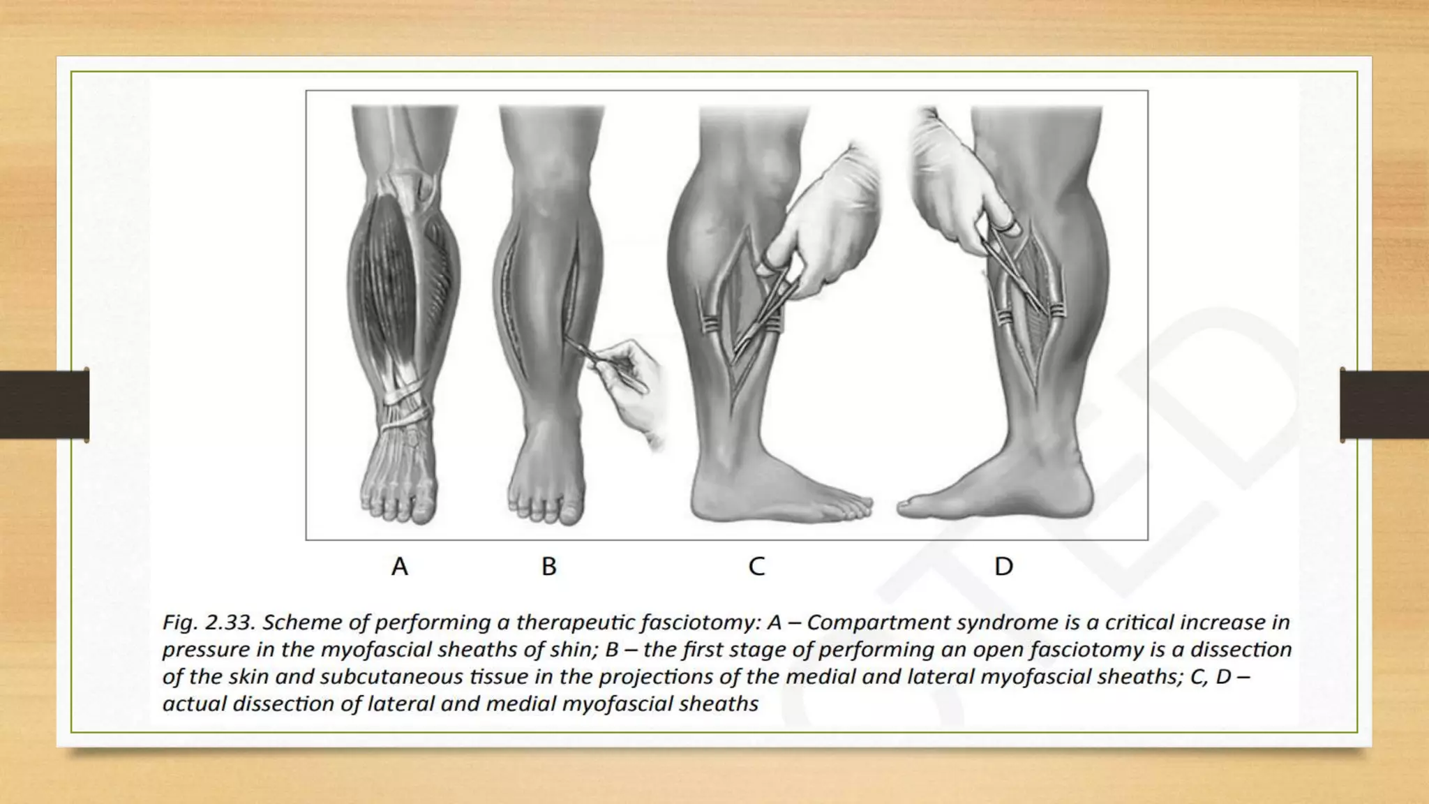 Compartment syndrome ppt.pptx