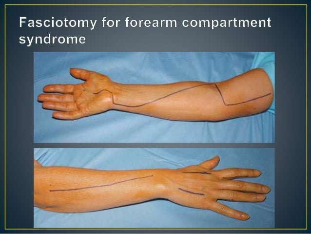 Compartment syndromes