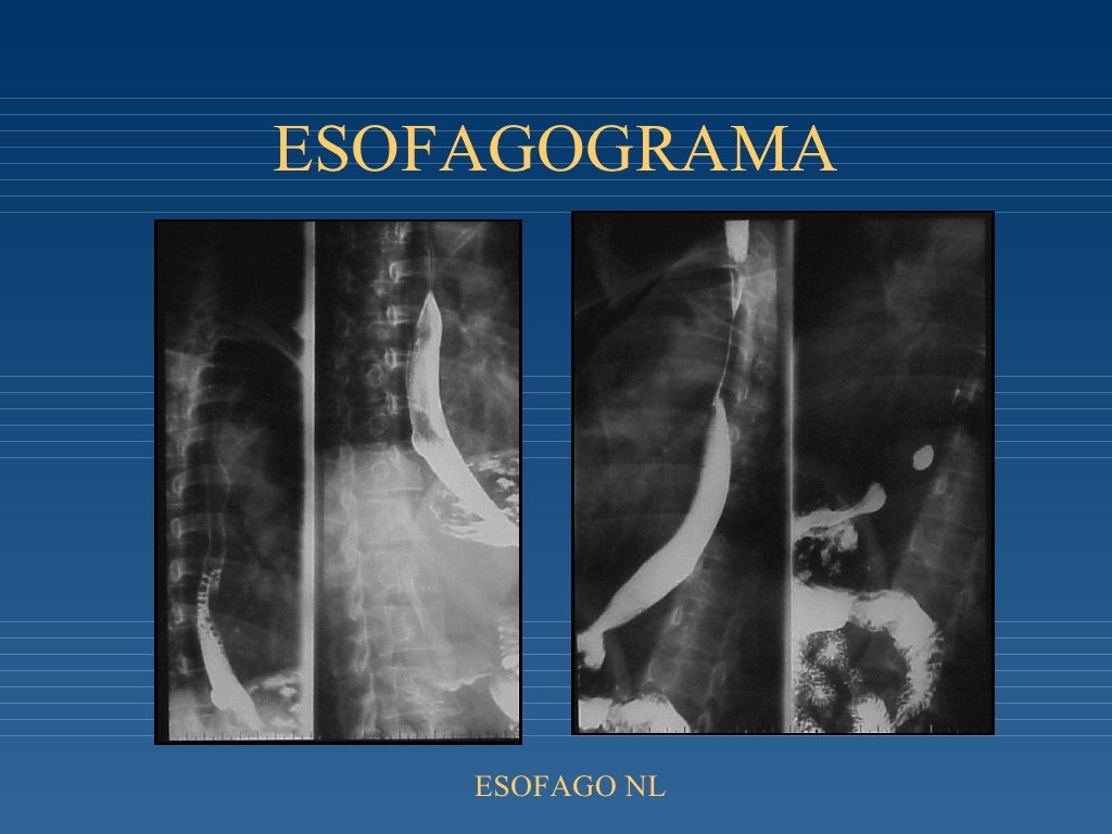Estudios Baritados del Tubo Digestivo