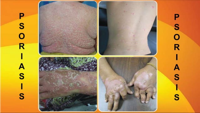 Compiled Scoring Systems in Dermatology_1650928171.pptx | Skin and Dermatology | Diseases and ...