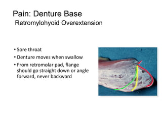 complaints of complete denture patients. | PDF