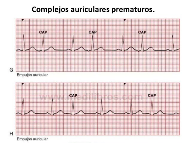 Complejos prematuros auriculares y ventriculares