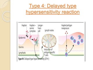 Complement and hypersensitivity | PPT