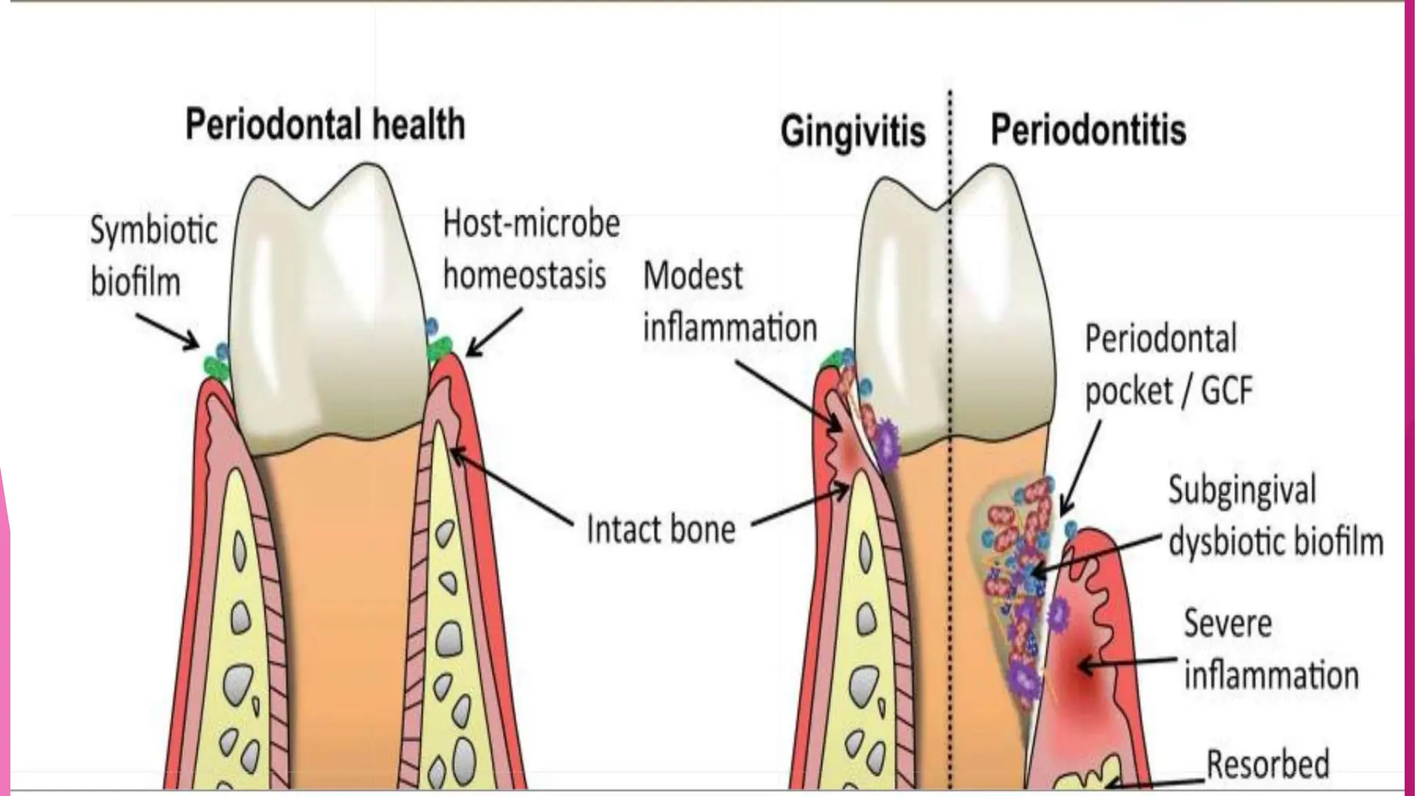 COMPLEMENT SYSTEM AND ITS ROLE IN PERIODONTAL INFLAMMATION.pptx