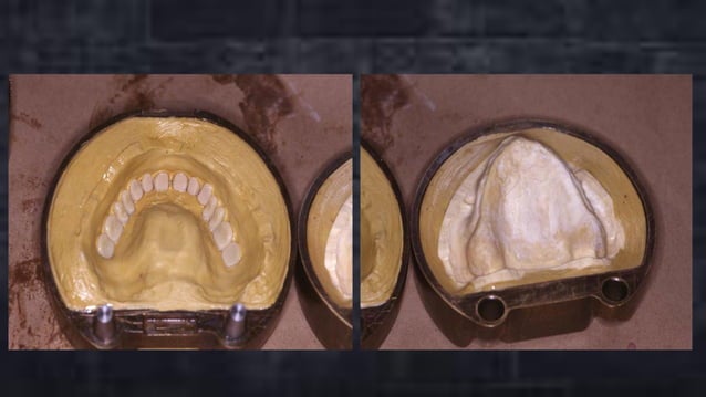 Complete denture processing & errors | PDF