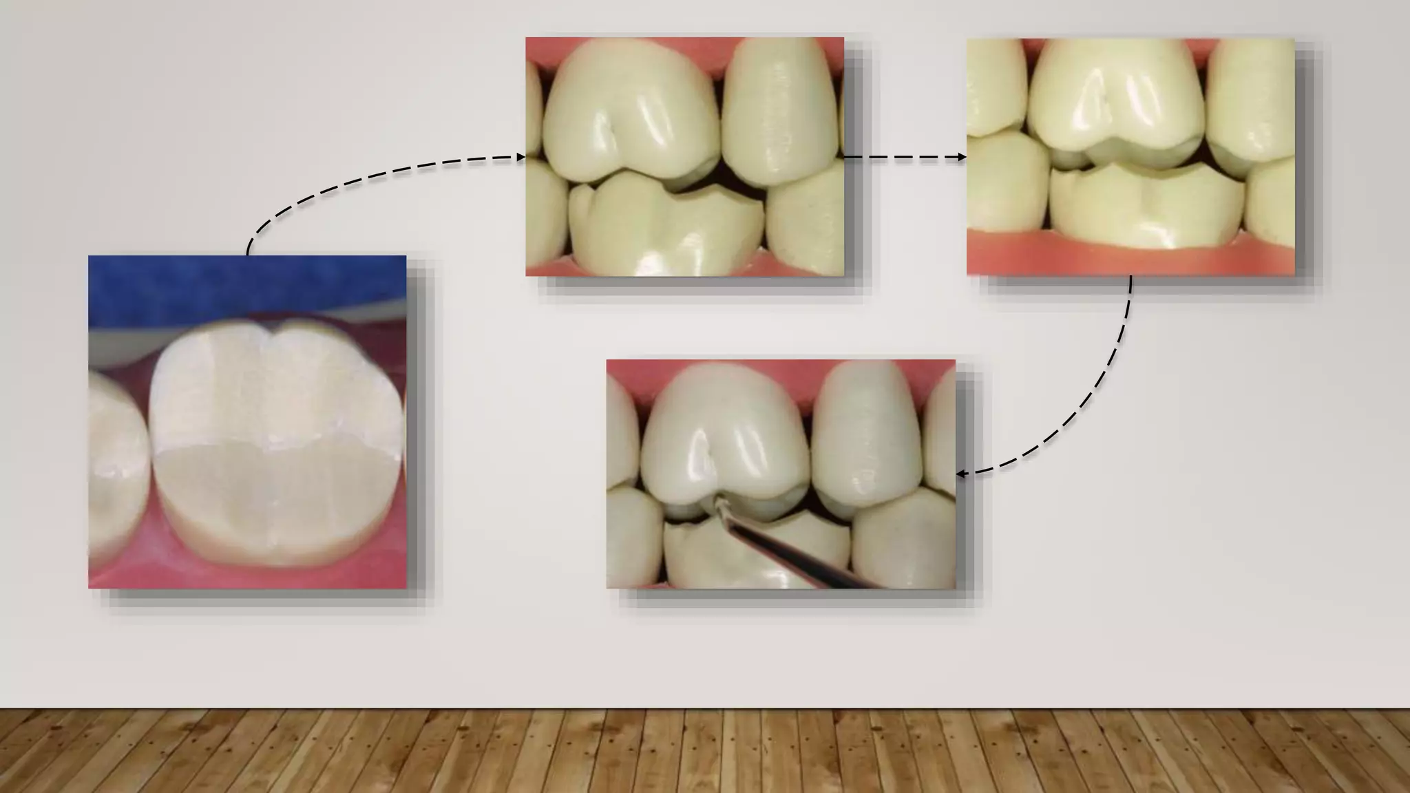 Complete cast crown | PPTX