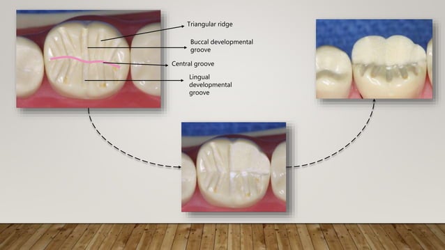 Complete cast crown | PPTX | Oral care | Personal Care