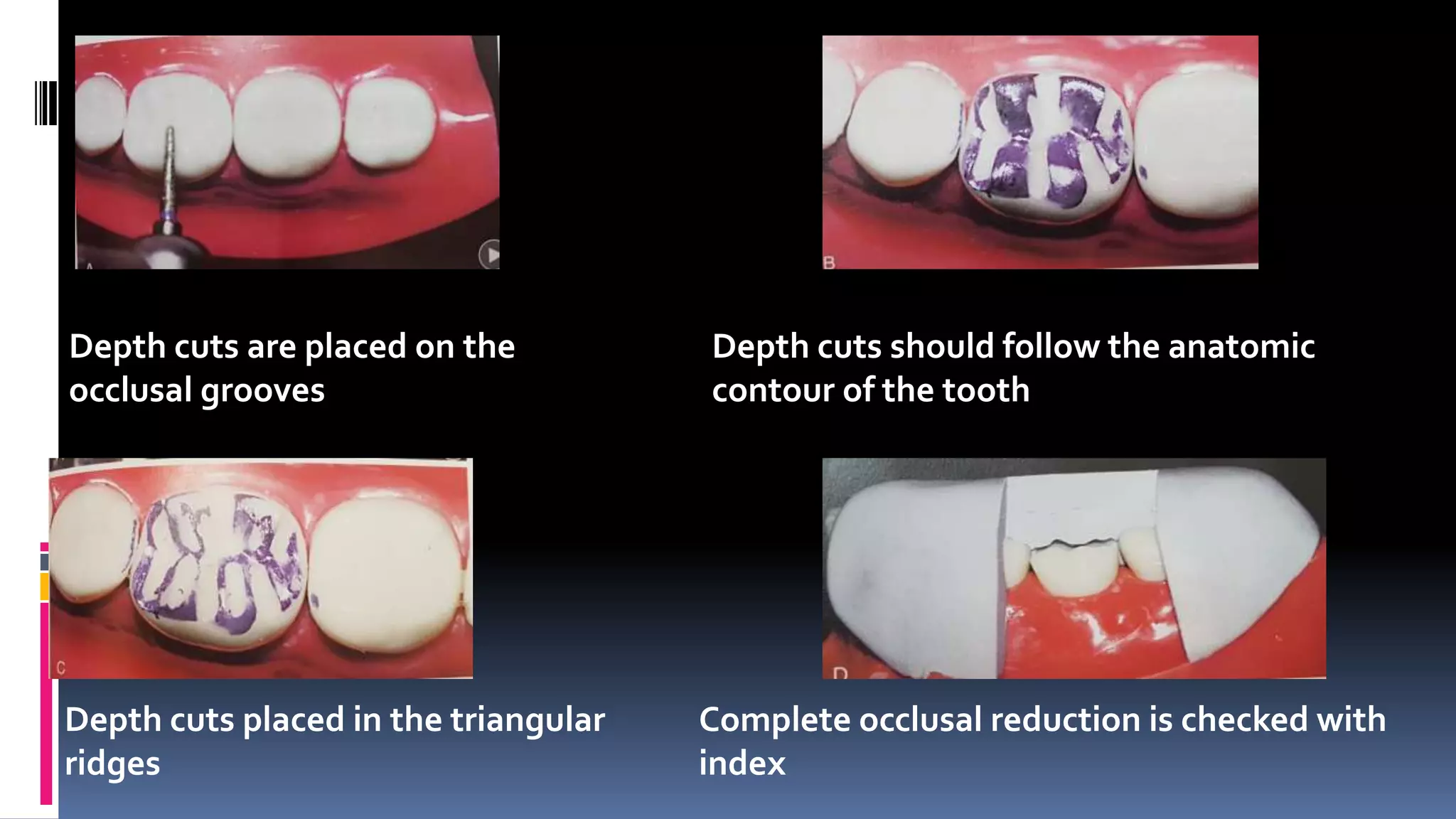 Tooth Preparation for full veneer crown | PPTX