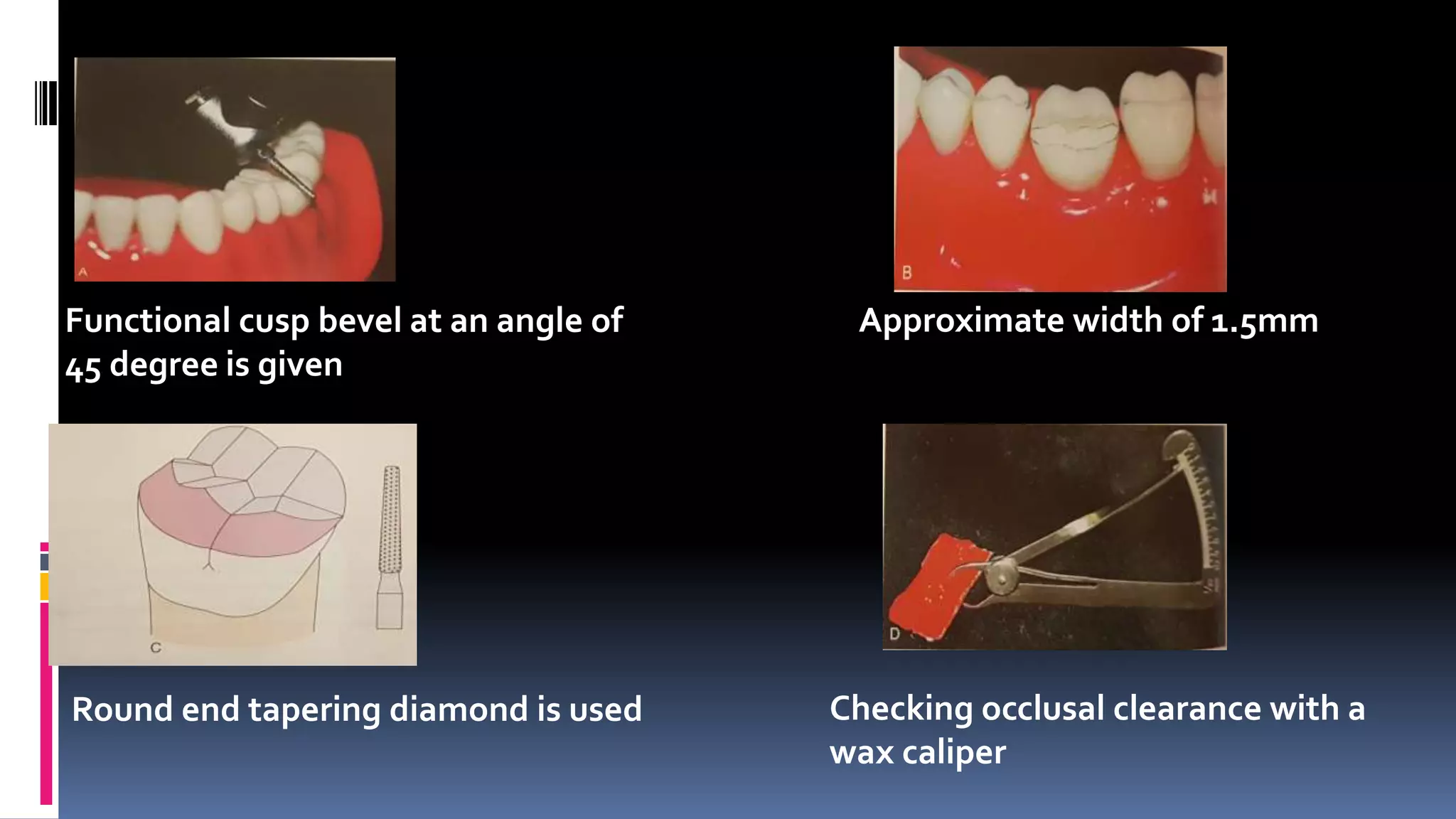Tooth Preparation for full veneer crown | PPTX