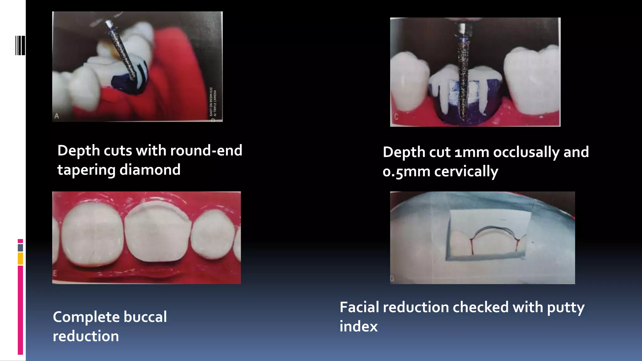 Tooth Preparation for full veneer crown | PPTX