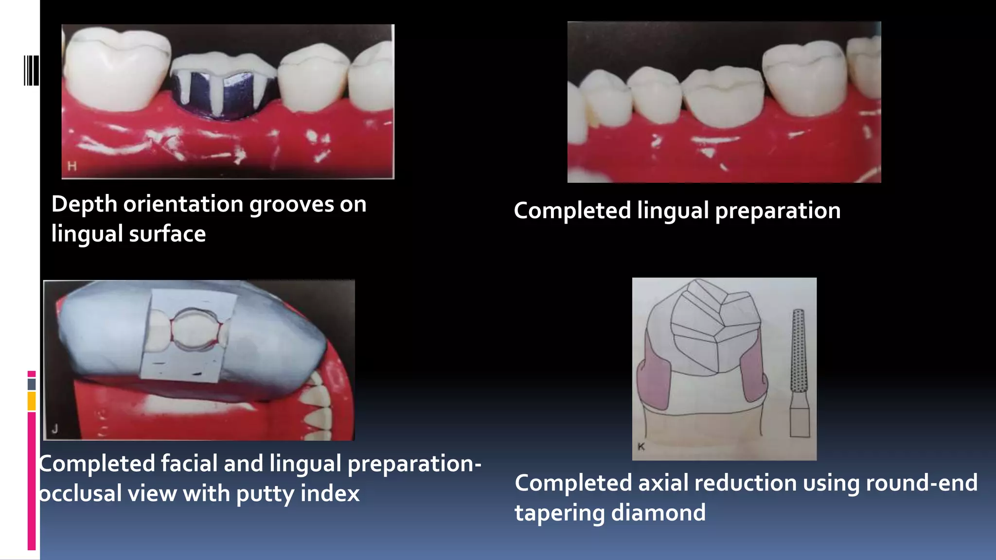 Tooth Preparation for full veneer crown | PPTX