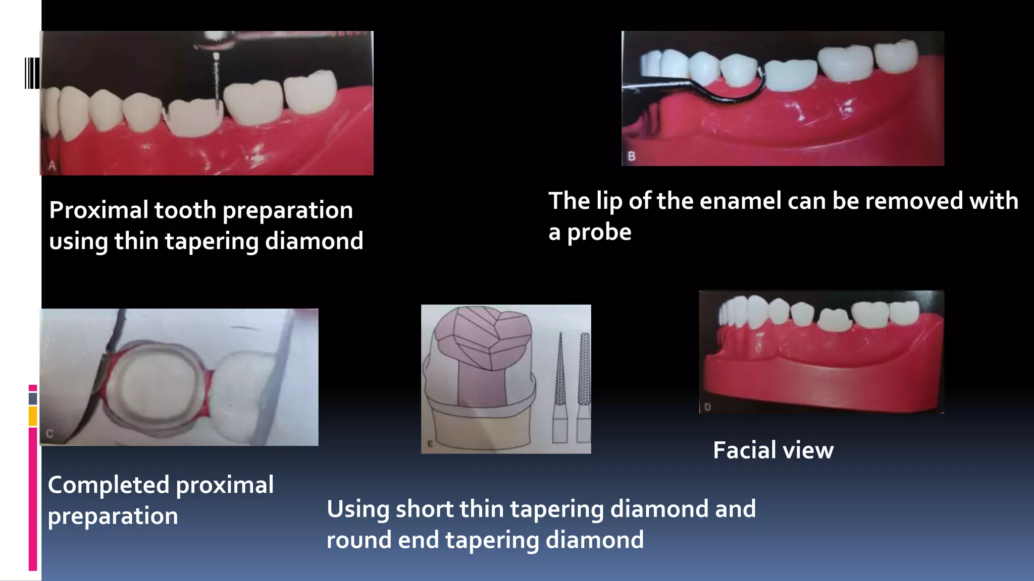 Tooth Preparation for full veneer crown | PPTX