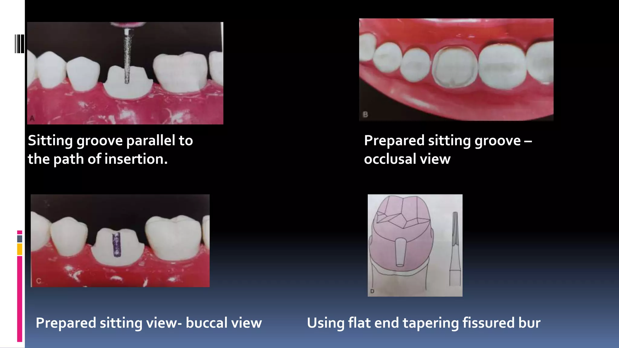Tooth Preparation for full veneer crown | PPTX
