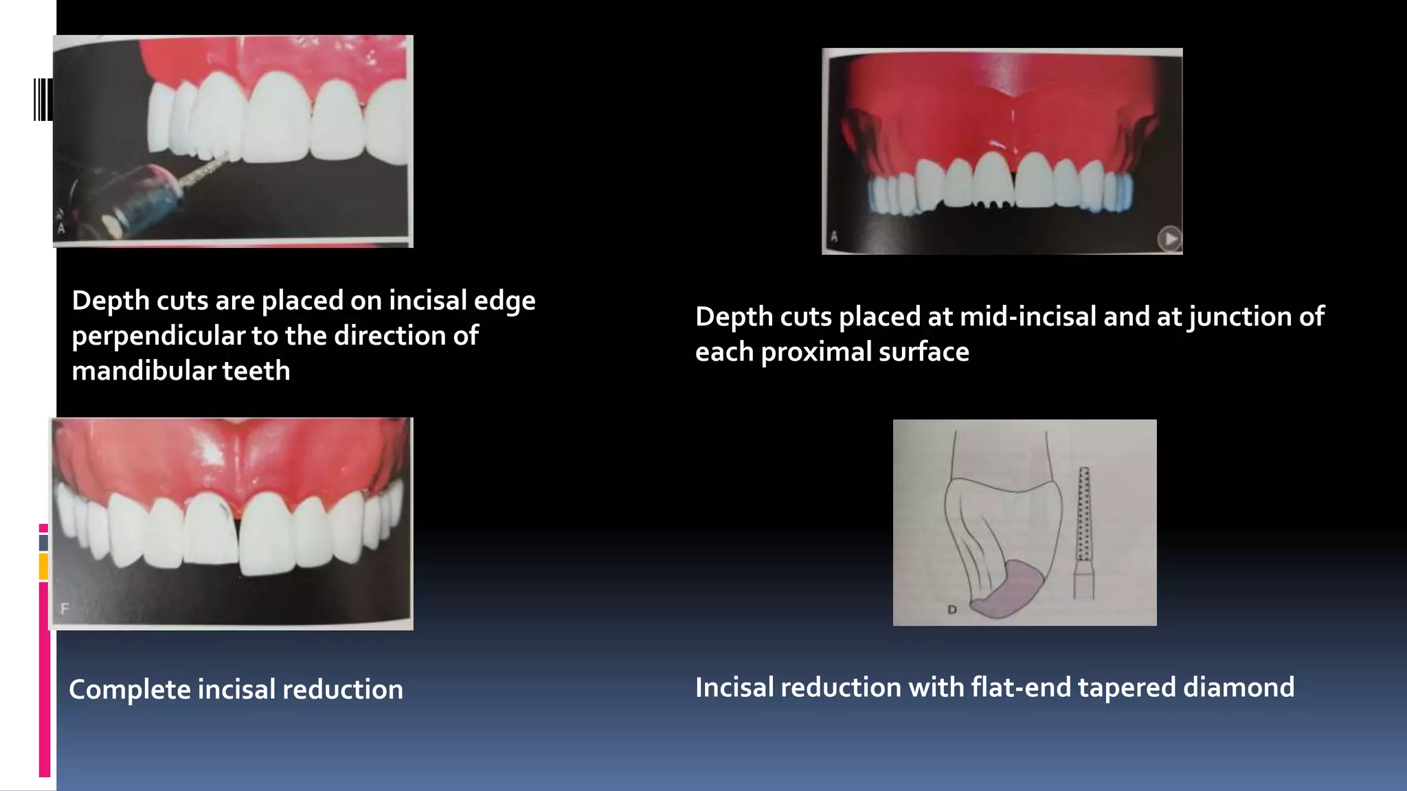 Tooth Preparation for full veneer crown | PPTX
